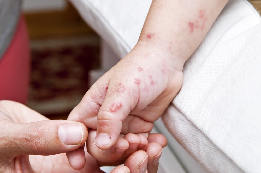 Zona Zoster la copii: de ce apare și ce trebuie să faci? - Naste natural