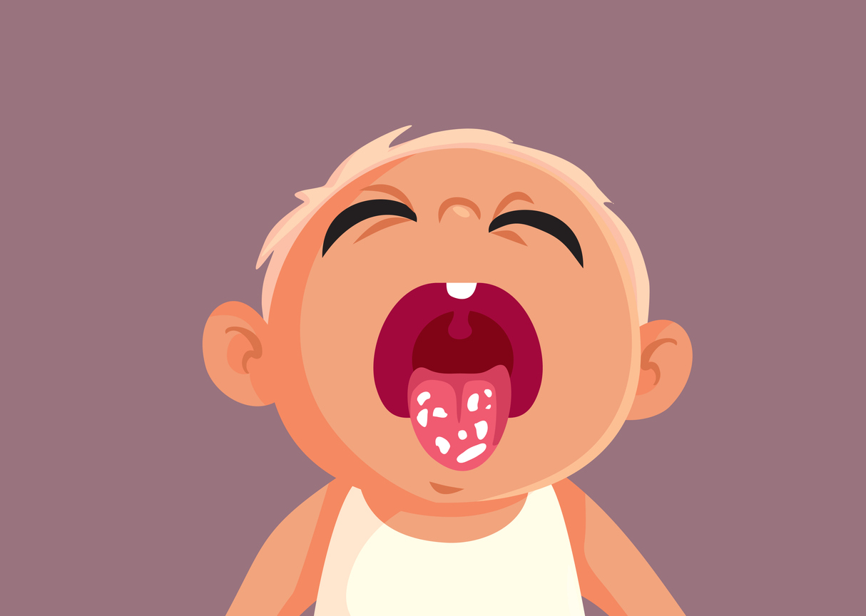 Little Baby Suffers from Candidiasis Vector Cartoon Illustration ...
